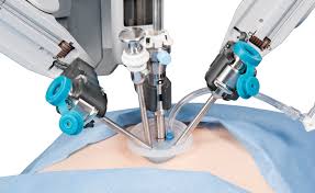 Single Incision Laparoscopic - magenopturkei.com